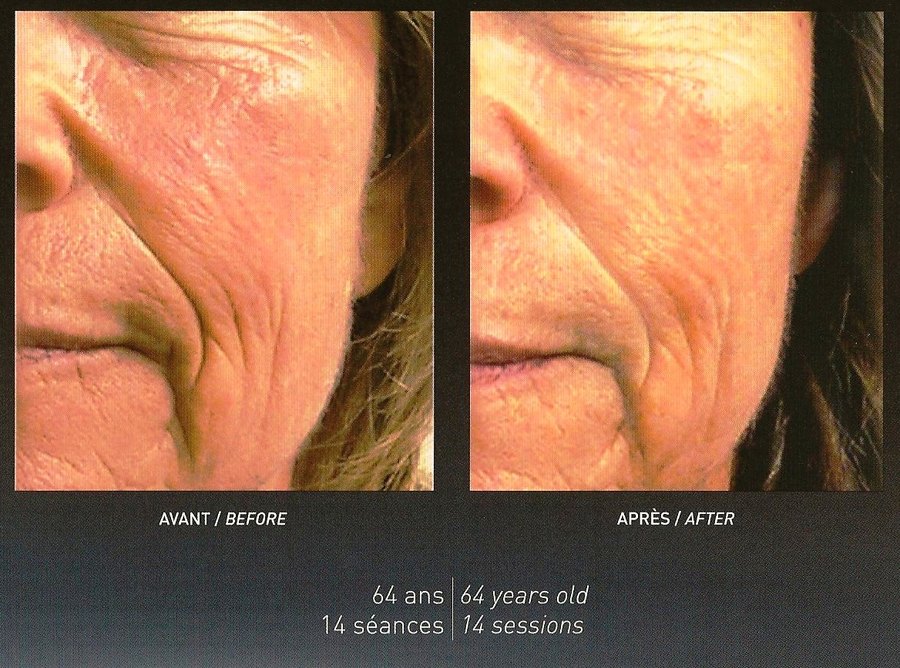 soins visage et corps par ultrason-photothérapie-lumiére led-lumiére ...
